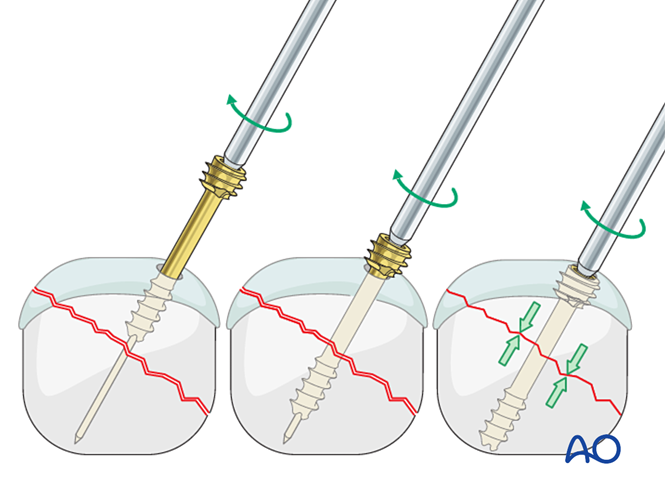 Headless compression screw insertion