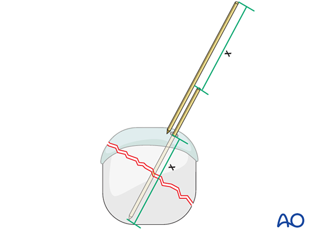 Headless compression screw insertion