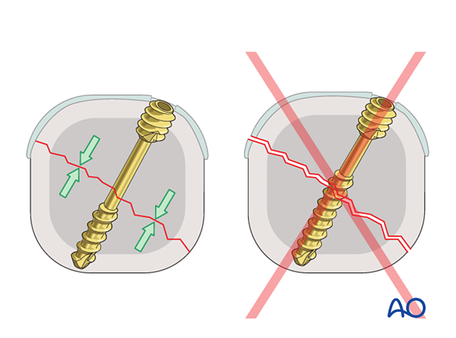 Headless compression screw insertion