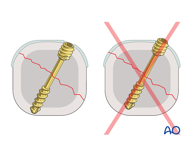 Headless compression screw insertion