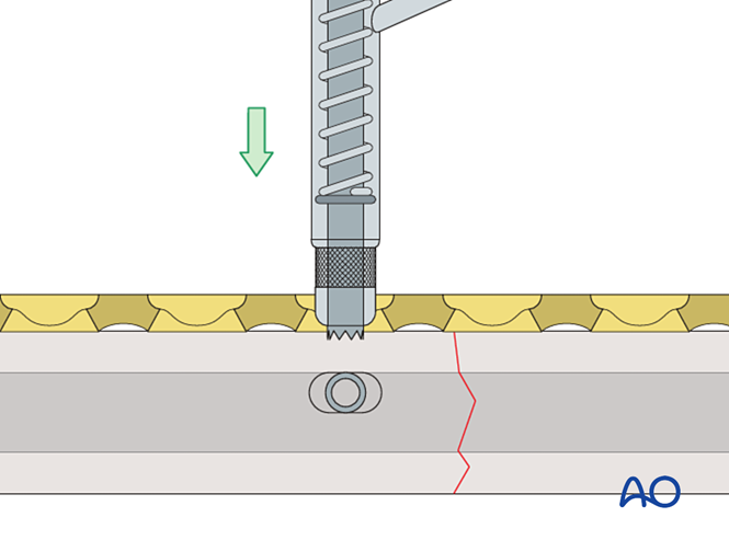 Screw insertion in neutral mode