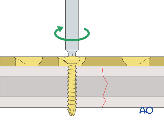 Basic techniques of fracture management