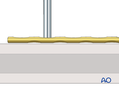 Locking head screw insertion