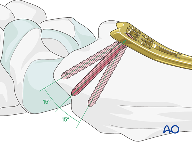 Locking head screw insertion
