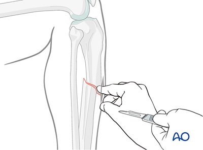 basic principles of im nailing new
