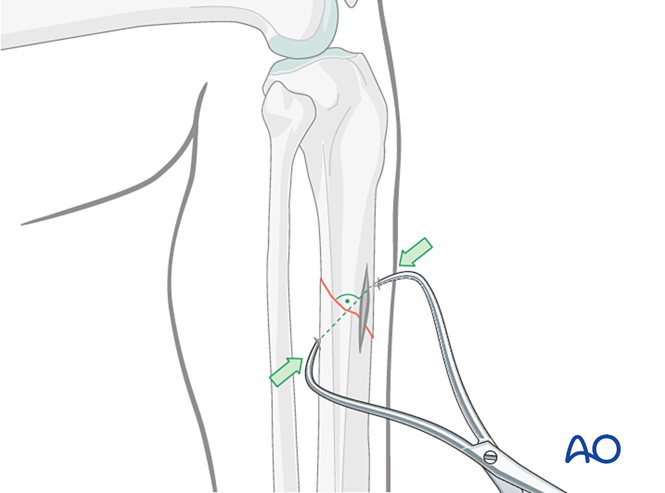 basic principles of im nailing new