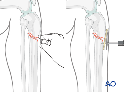 basic principles of im nailing new
