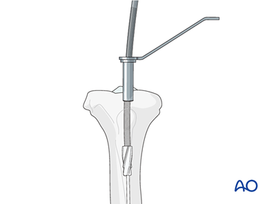 basic principles of im nailing new