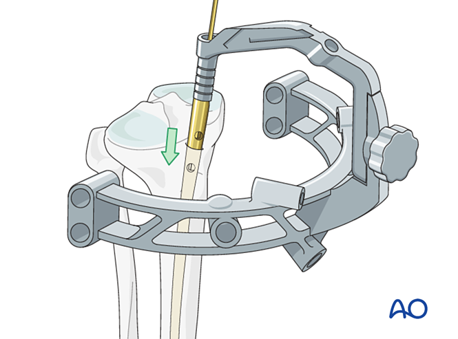 basic principles of im nailing new