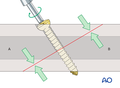 Basic techniques of fracture management