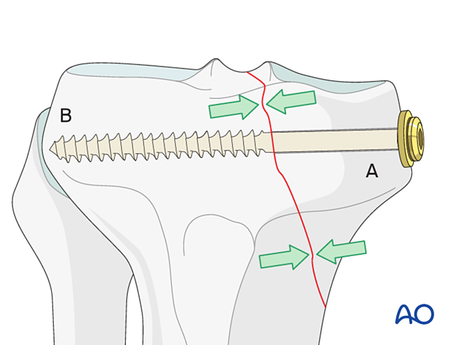 Basic techniques of fracture management