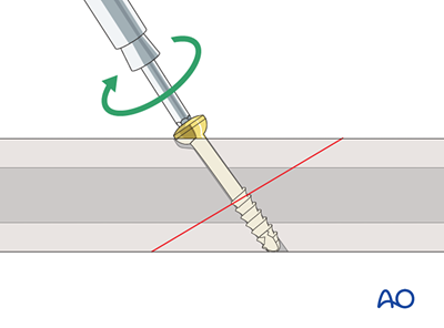 Cortical lag screw insertion
