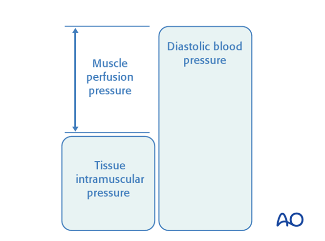 Compartment syndrome