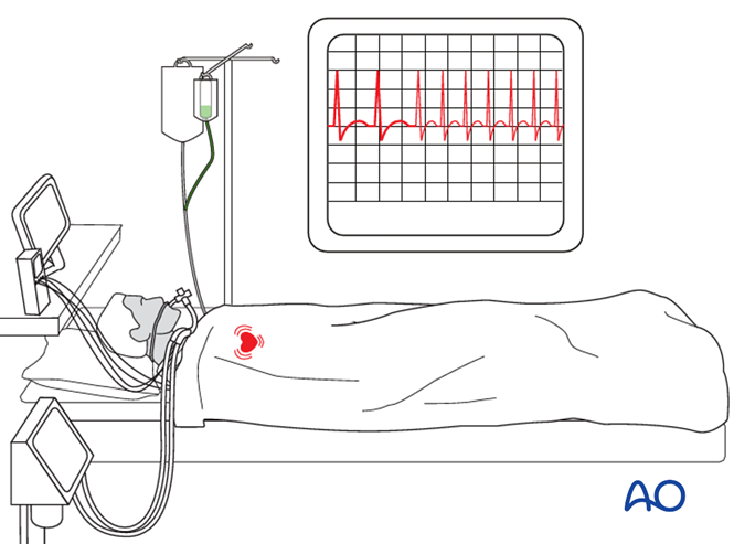 Compartment syndrome