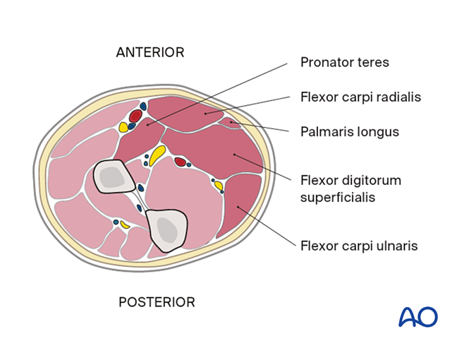 Compartment syndrome arm
