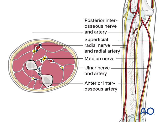 Compartment syndrome arm
