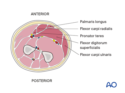 Compartment syndrome arm