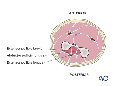Compartment syndrome arm