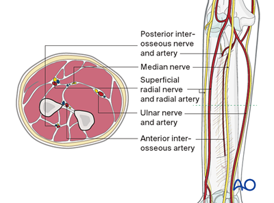 Compartment syndrome arm
