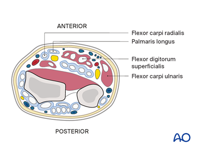 Compartment syndrome arm