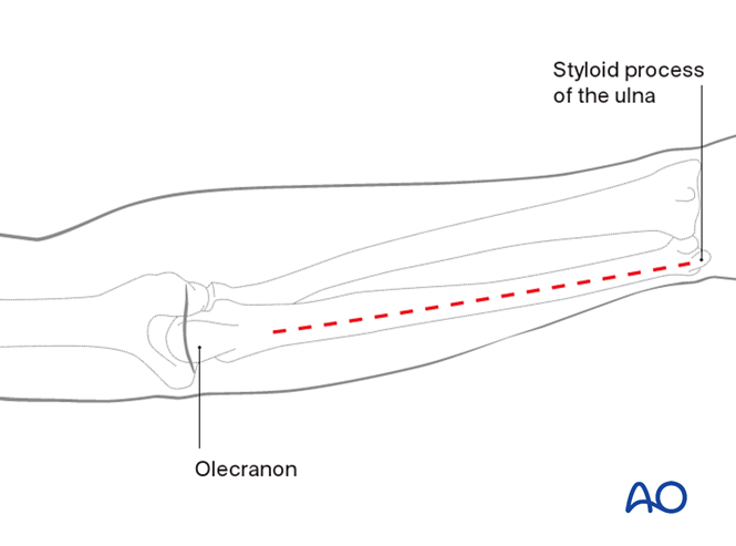 Compartment syndrome arm