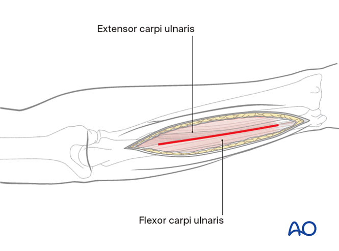 Compartment syndrome arm