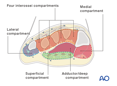 Compartment syndrome in the foot