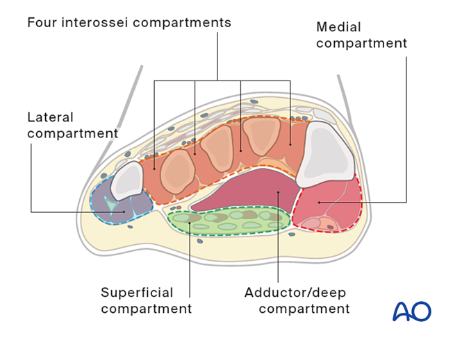 Compartment syndrome in the foot