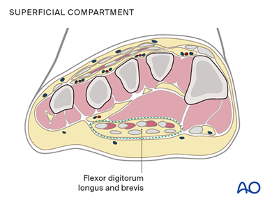 Compartment syndrome in the foot