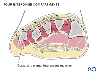 Compartment syndrome in the foot