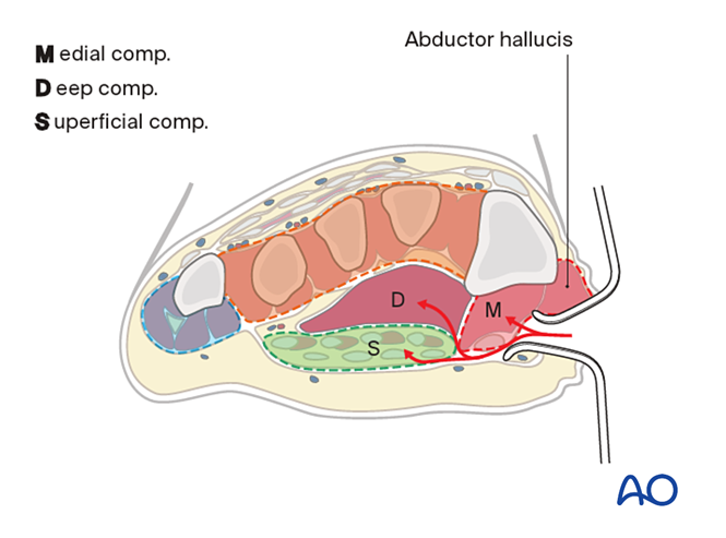 Compartment syndrome in the foot