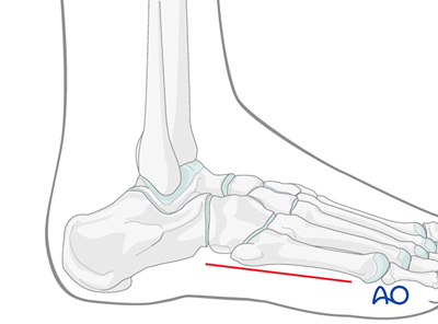 Compartment syndrome in the foot