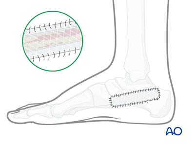Compartment syndrome in the foot