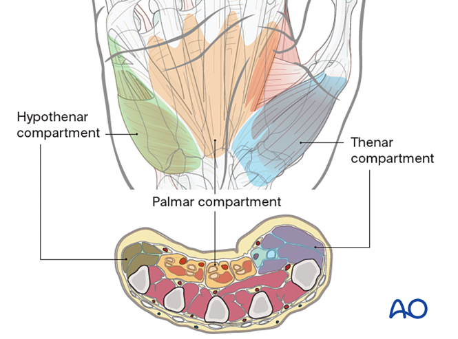 Compartment syndrome hand