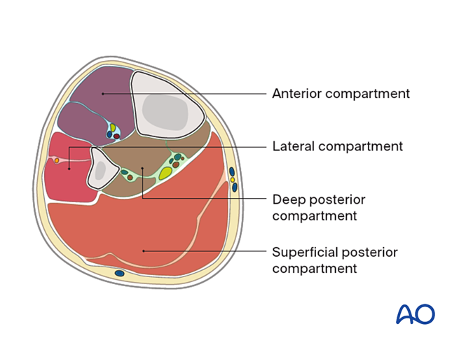 Compartment syndrome in the leg