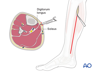 compartment syndrome in the leg