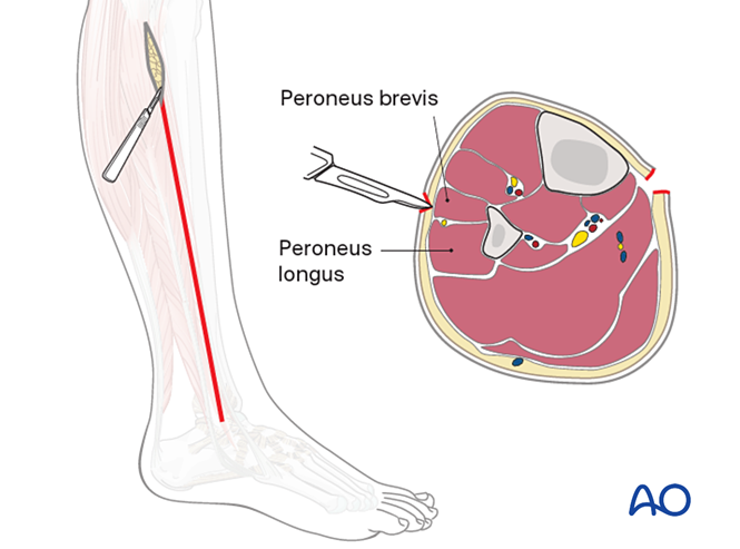 Compartment syndrome in the leg