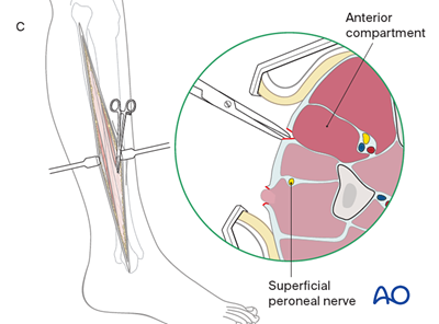 Compartment syndrome in the leg