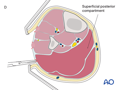 compartment syndrome in the leg
