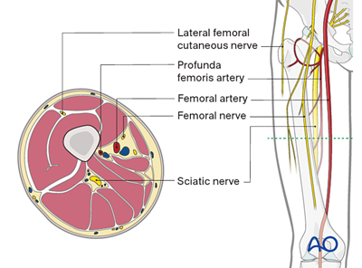 Compartment syndrome in the thigh