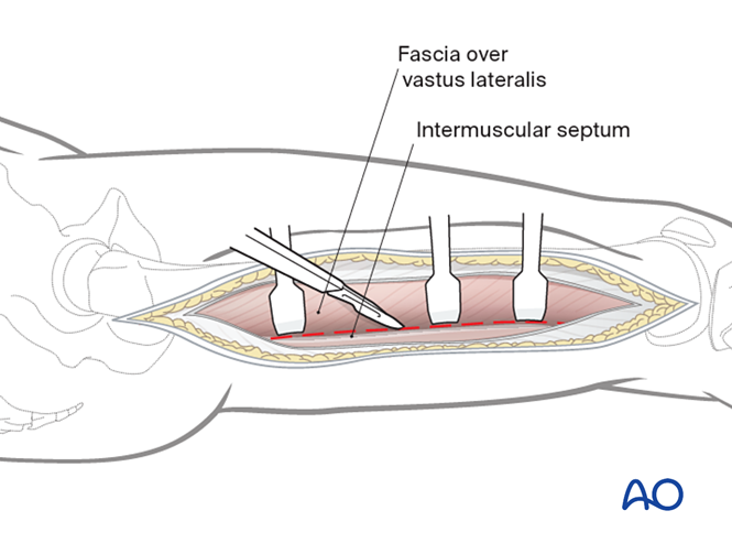 Compartment syndrome in the thigh