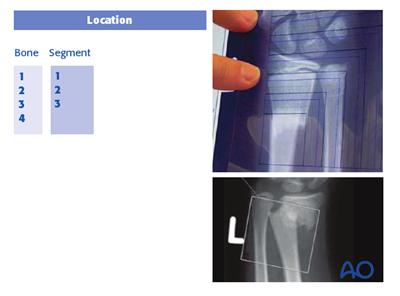 Classification of children’s fractures