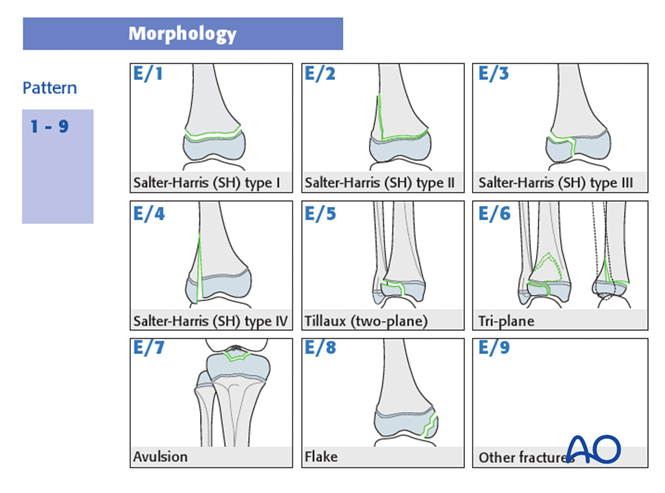 Classification of children’s fractures