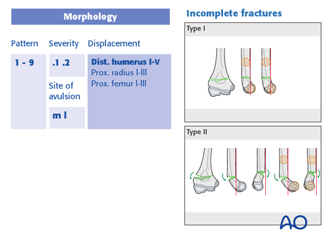 Classification of children’s fractures