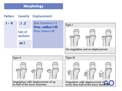Classification of children’s fractures