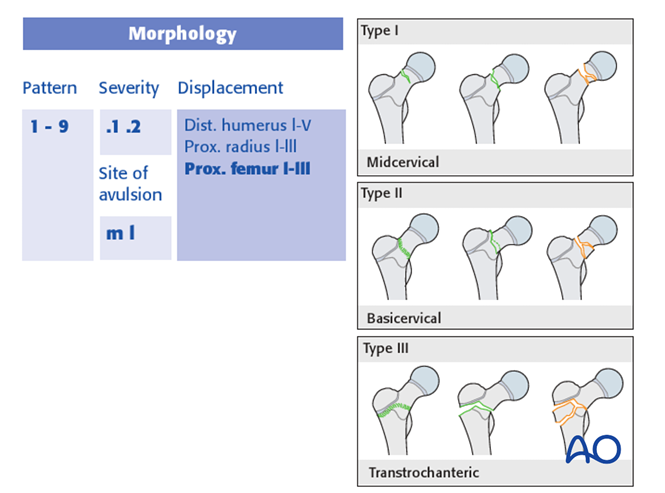 Classification of children’s fractures