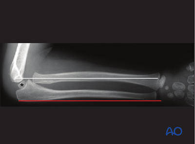 Principles of nonoperative treatment of children’s fractures