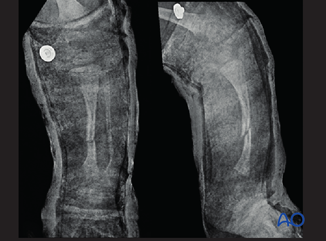 Fractures in abnormal bone