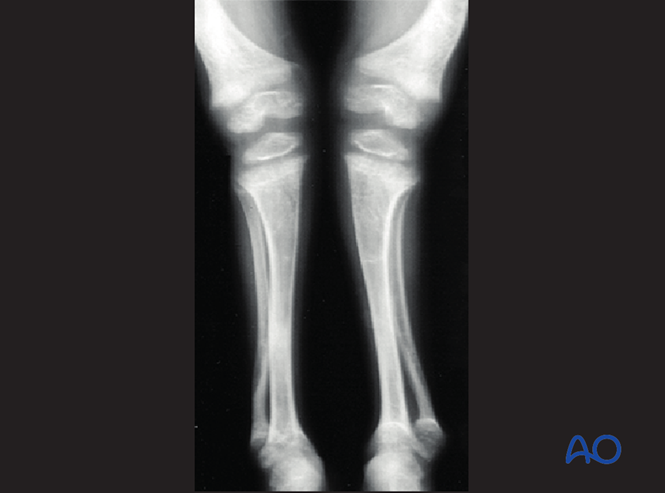 Fractures in abnormal bone