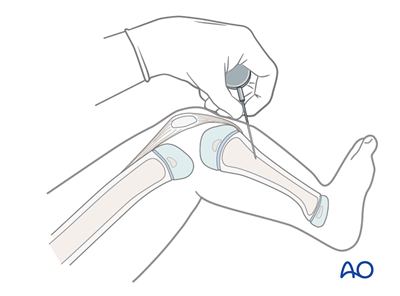 Pediatric polytrauma